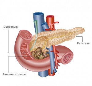 Addressing the Challenges of Treating Pancreatic Cancer - New Hope ...